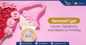 Dermoid Cyst Causes, Symptoms, and Impact on Fertility